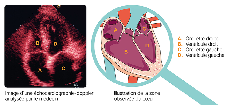Comment diagnostiquer une insuffisance cardiaque