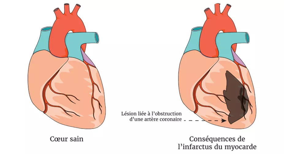 Crise Cardiaque Lapin Causes – Crise Cardiaque Symptômes – SQMKS